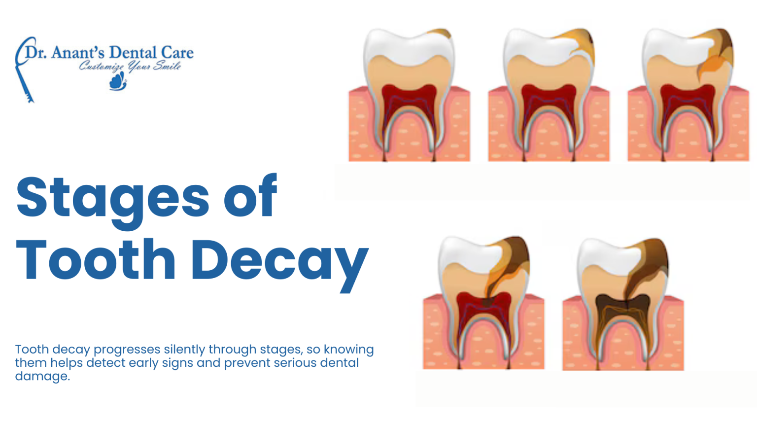 5 Stages of Tooth Decay: Causes, Symptoms & Prevention